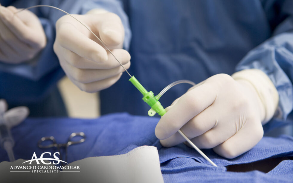 Cardiac Catheterization: Transradial vs. Transfemoral Procedure ...