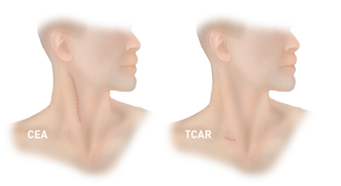 TCAR Procedure in Shreveport, Louisiana