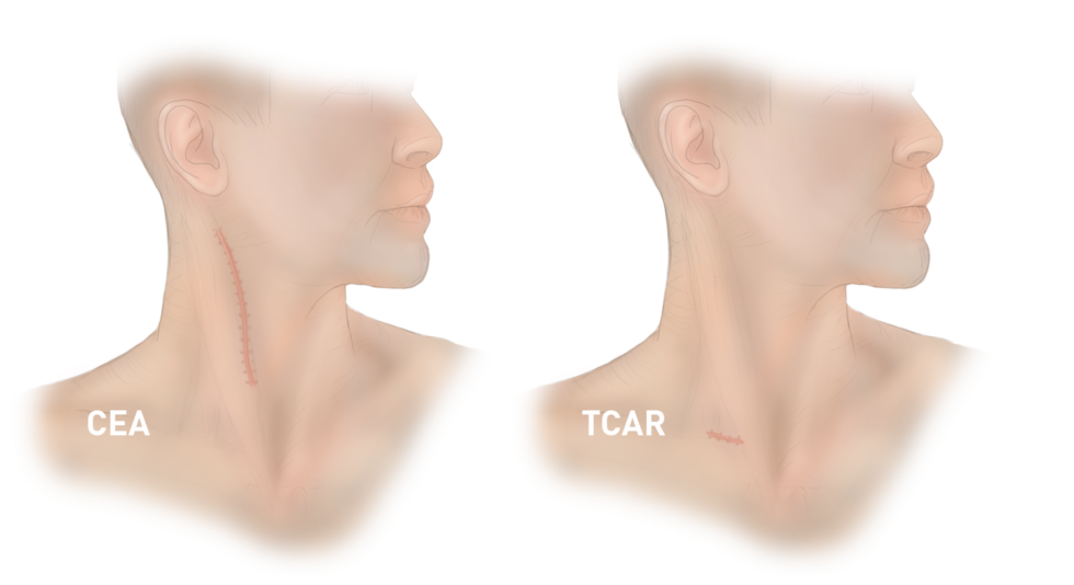 TCAR Procedure in Shreveport, Louisiana